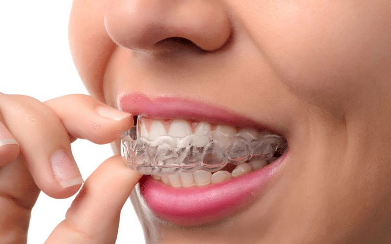 How to Relieve Sharp Edges Of Invisalign?