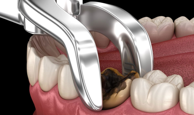 Tooth Extraction Pain After 7 Days: Causes & Solutions