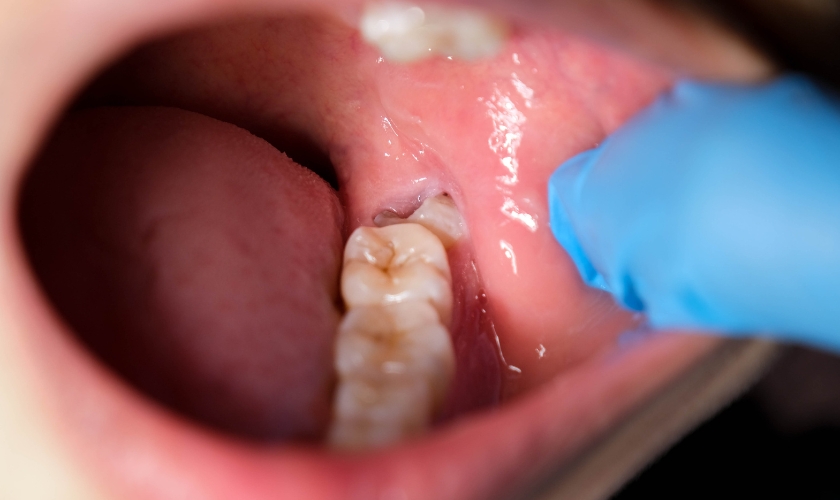 Wisdom Tooth Infection: Signs, Symptoms & Treatments