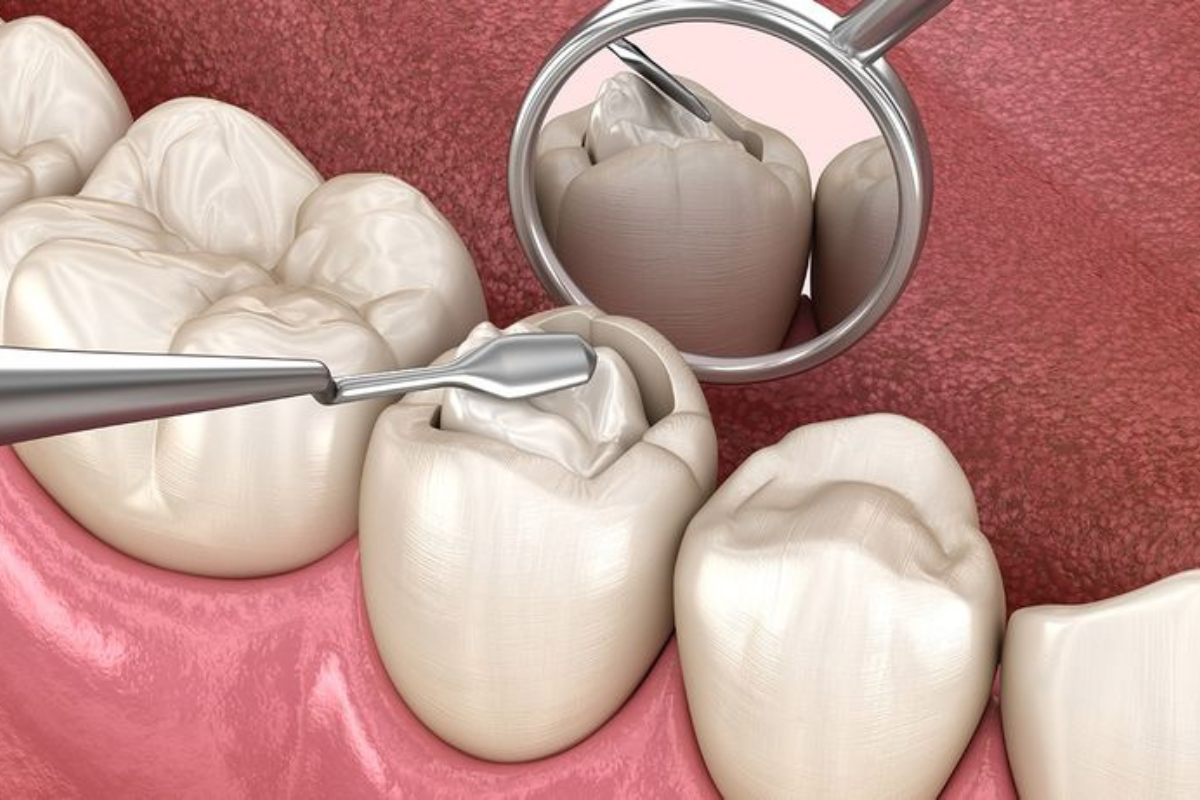 How Dental Fillings Prevent Cavities & Protect Teeth?